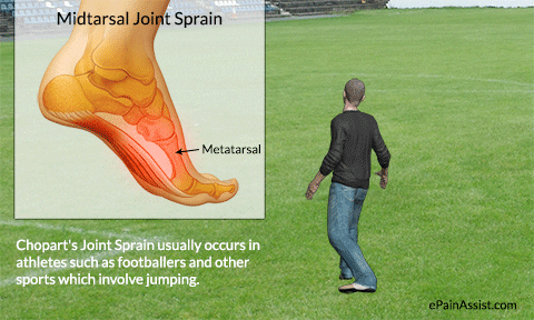 Which Are The Ligaments That Get Injured In Midtarsal Joint Sprain? GIF ...