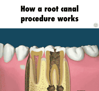 Root Canal GIFs - Get the best GIF on GIPHY