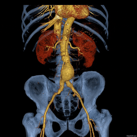 Abdominal Aortic Aneurysm GIFs - Find & Share on GIPHY