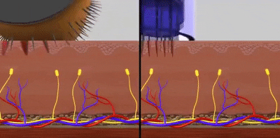 Microneedling Derma Pen At Home | Safe And Painless Treatment For Skin ...