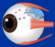 Glaucoma GIFs - Get the best GIF on GIPHY