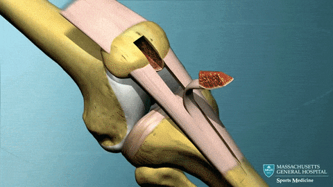 Acl GIFs - Find & Share on GIPHY