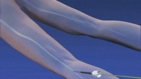 Treatment Vein GIF - Find & Share on GIPHY