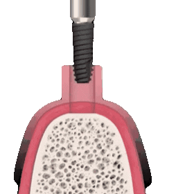 Sq Implant Sticker by DENTIS_USA for iOS & Android | GIPHY