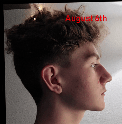 See any progress? May 26 to August 6 : Mewing