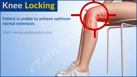 Knee Locking: What Can Cause Your Knee To Get Locked? GIF by ...
