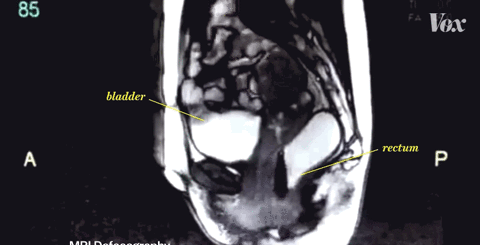 Mri GIF - Find & Share on GIPHY