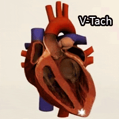 Cardiac Arrhythmia GIFs - Get the best GIF on GIPHY